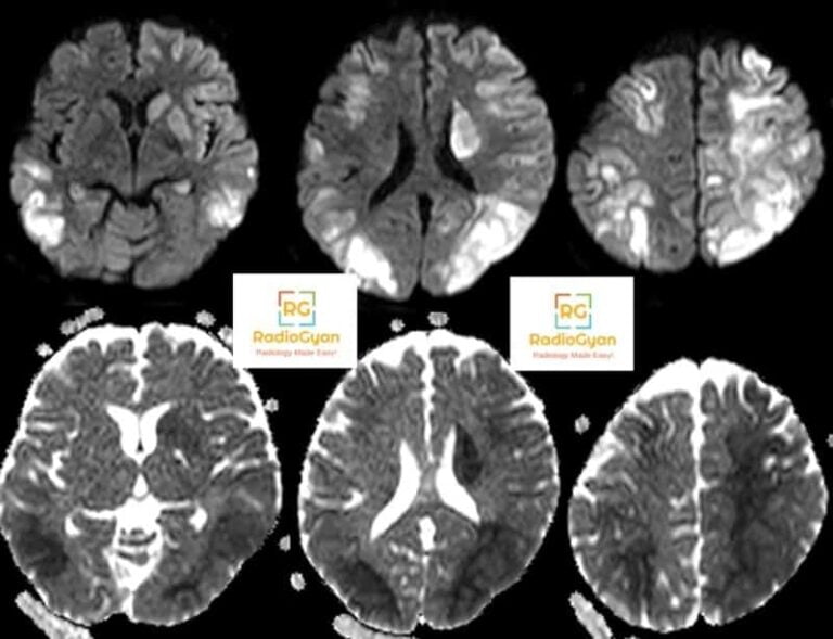 Hypoxic Ischemic encephalopathy | Radiology Case | RadioGyan