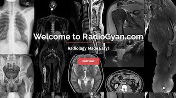 String sign | Radiology Signs
