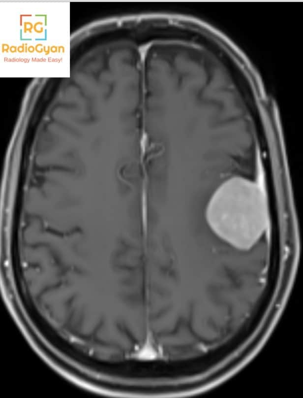 Normal radiology measurements and reference values (2020) | Radiogyan ...