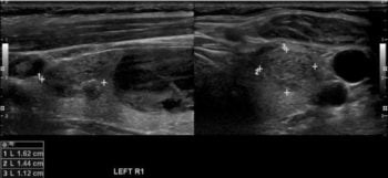 TIRADS : What Radiologists need to know | RadioGyan.com