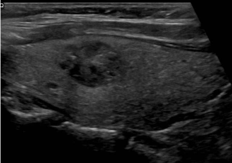 TIRADS : What Radiologists need to know | RadioGyan.com