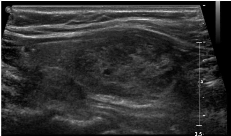 TIRADS ACR : What a radiologist needs to know! | RadioGyan .com