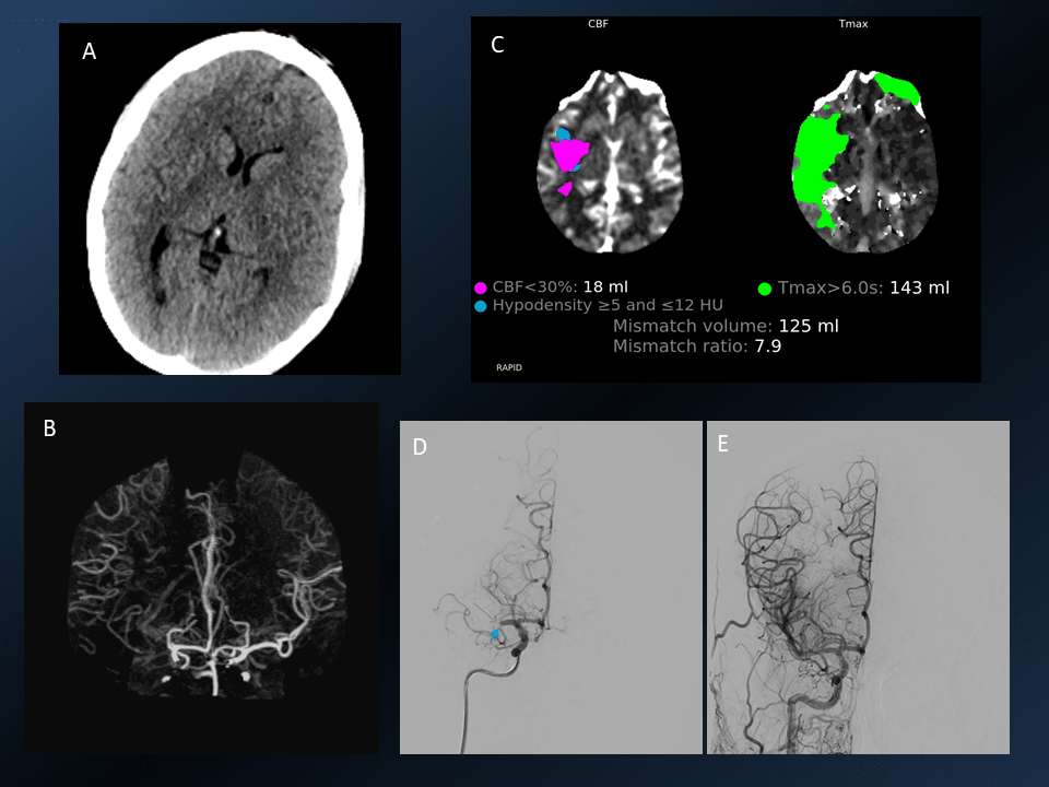 Interventional Radiology - All Your Questions Answered | Guides | RadioGyan