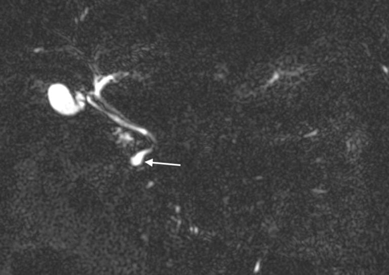 Choledochal Cyst and Anomalous Pancreaticobiliary Junction - Radiology ...