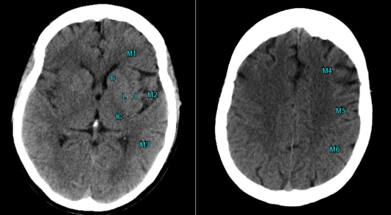 Modified CT Severity Index Calculator for Pancreatitis