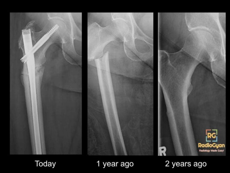 Proximal Femoral Fractures - Radiology Case