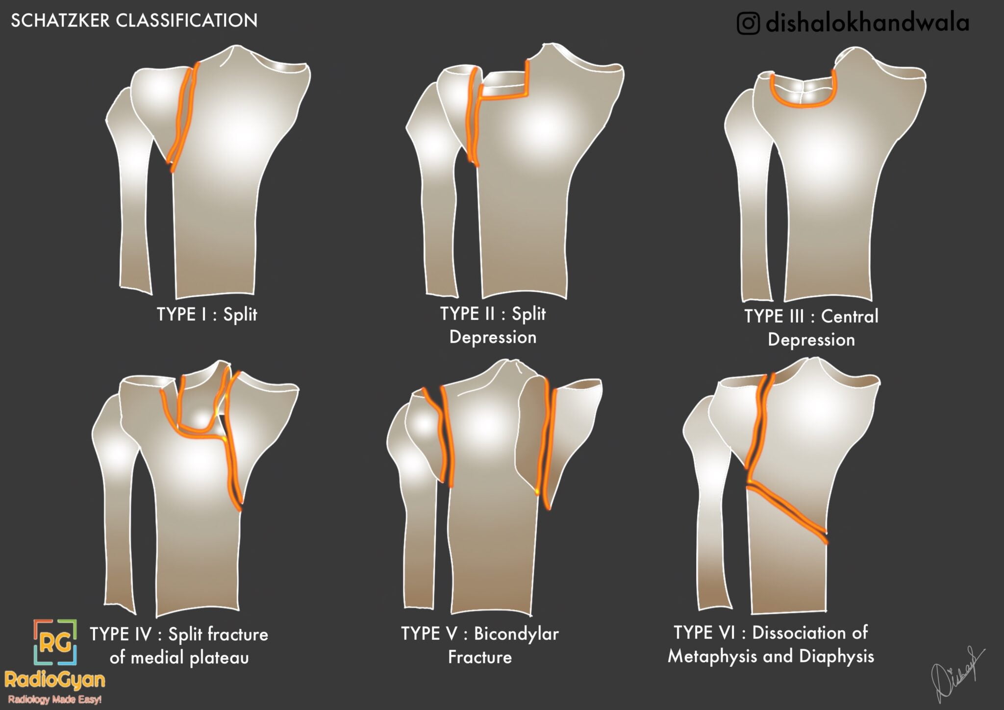 Schatzker Classification of Tibial Plateau Fractures