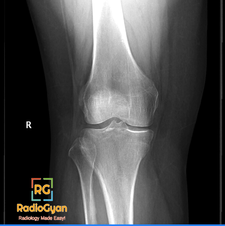 Schatzker Classification of Tibial Plateau Fractures