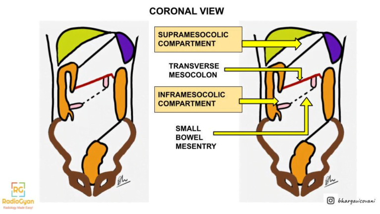The Potential Spaces-Mapping the Peritoneal Cavity - RadioGyan .com