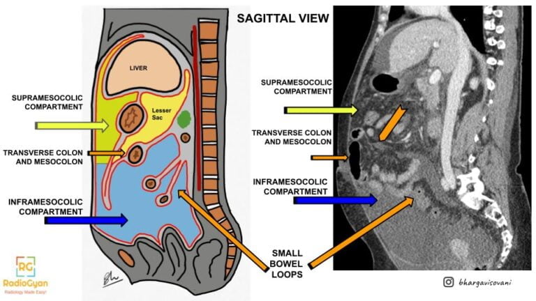 The Potential Spaces-Mapping the Peritoneal Cavity - RadioGyan .com