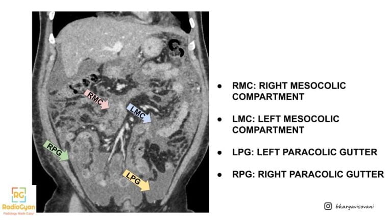 The Potential Spaces-Mapping the Peritoneal Cavity - RadioGyan .com