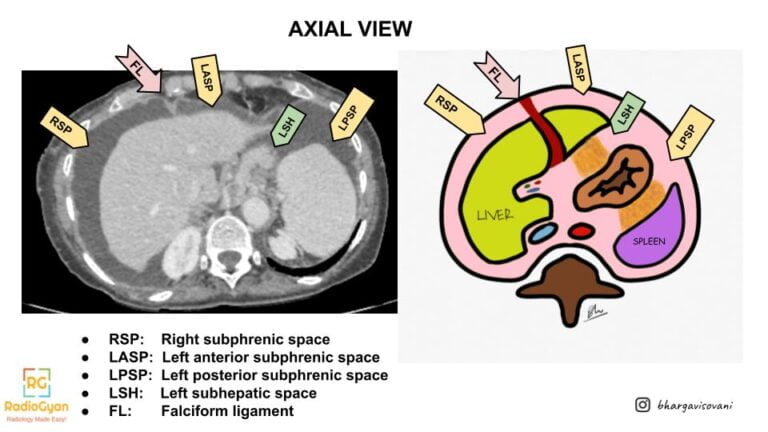 The Potential Spaces-Mapping the Peritoneal Cavity - RadioGyan .com