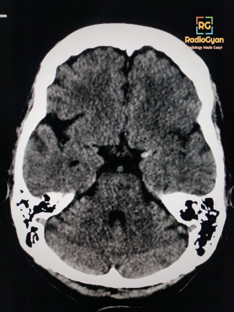 Dense MCA sign | Radiology Signs