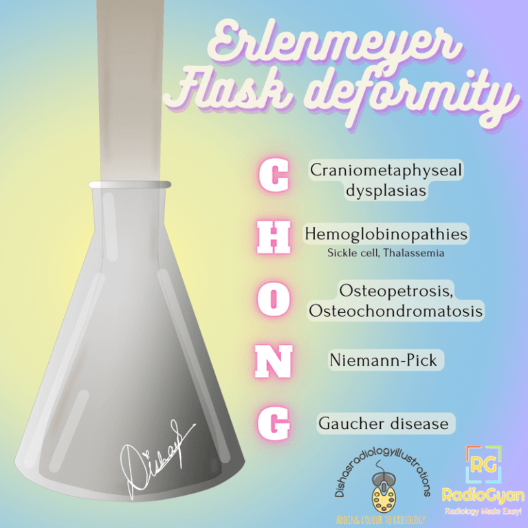 Causes Of Erlenmeyer Flask Deformity - Visual Mnemonics