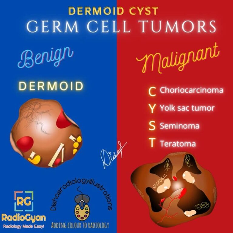 Germ Cell Tumors Subtypes - Visual Mnemonics