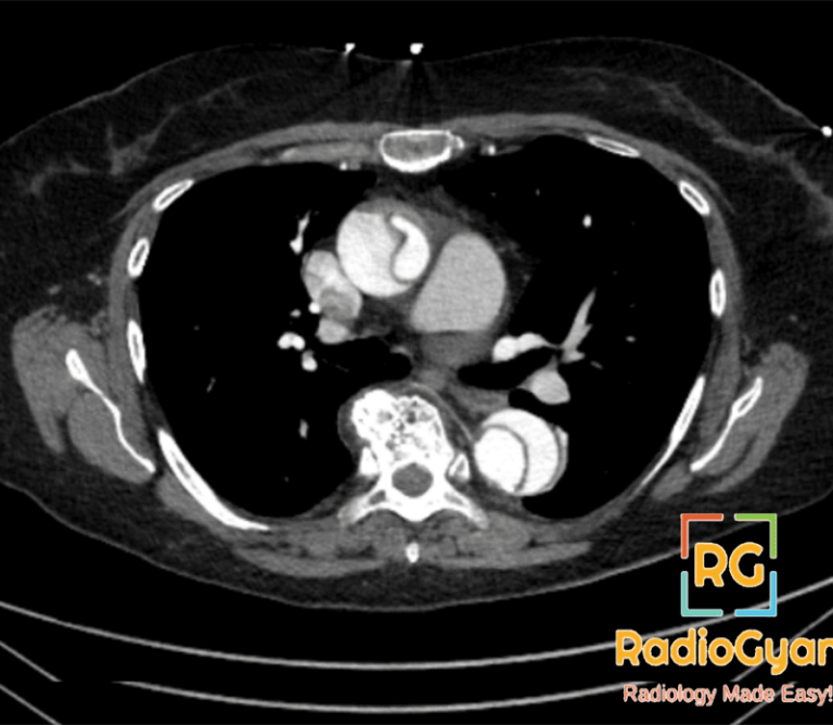 Aortic Dissection | Radiology Reference Article