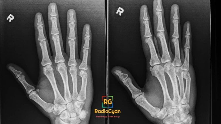 Boxer's Fracture [Why is it A Misnomer?] | Radiology Case