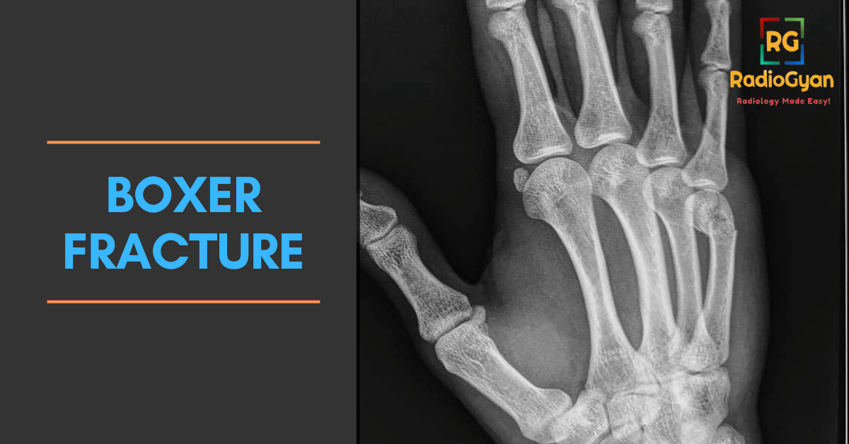 Boxer's Fracture [Why is it A Misnomer?] | Radiology Case