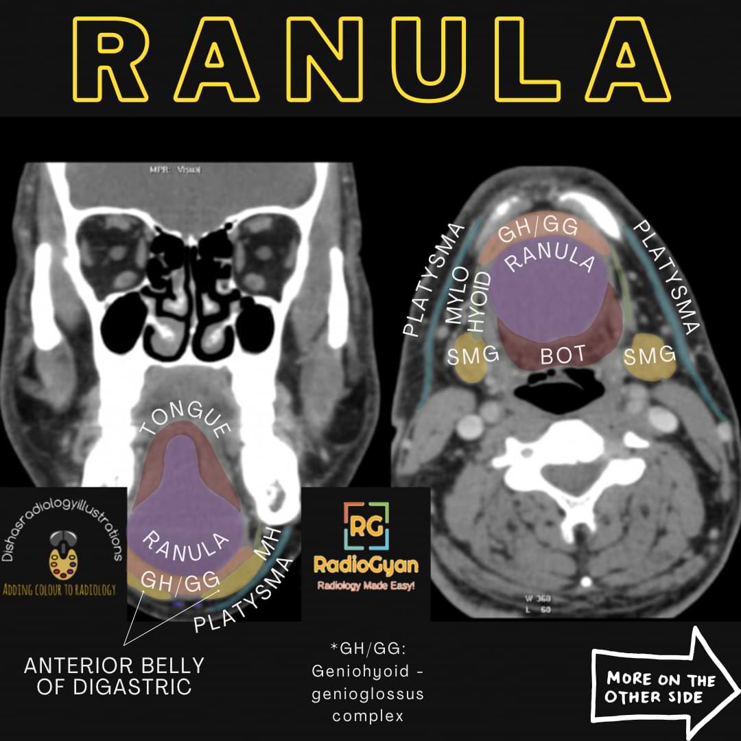Ranula Radiology Case Ranula Radiology Case