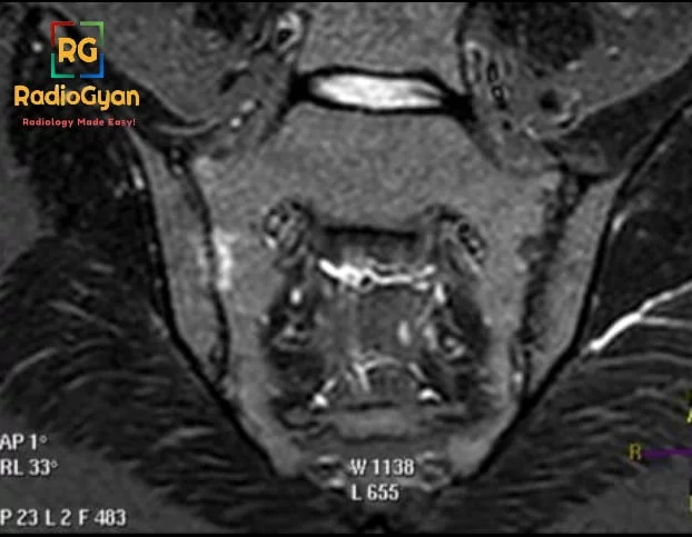 Sacroilitis | Radiology Case | - RadioGyan