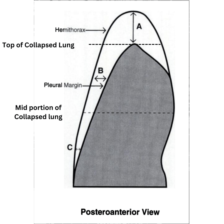 Pneumothorax Percentage Calculator