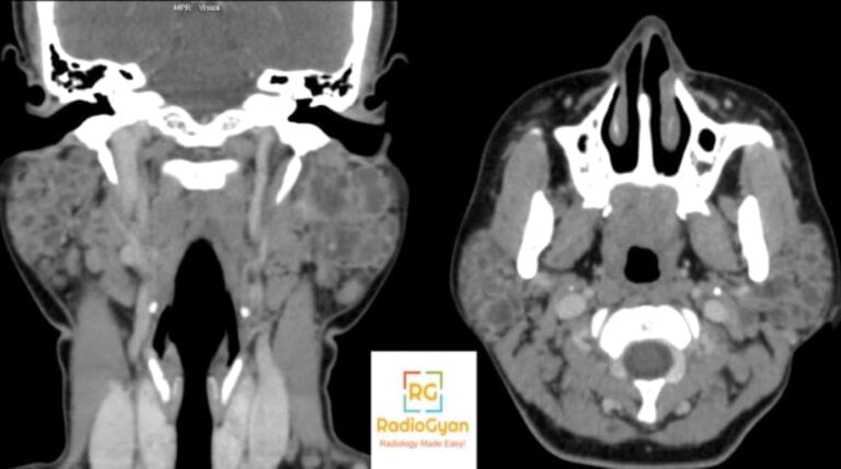 Benign Lymphoepithelial Cysts of the Parotid Gland | Radiology Case