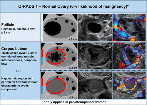O-RADS Ultrasound Calculator - RadioGyan