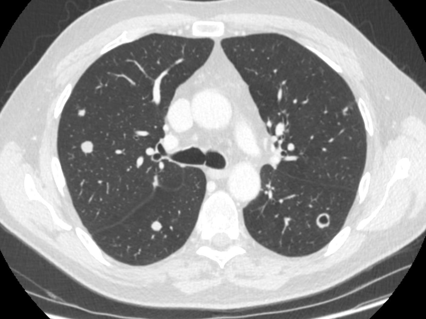Causes Of Pulmonary Cavity - Visual Mnemonics