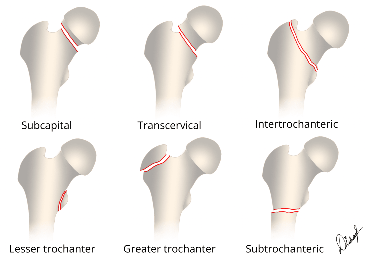 Proximal Femoral Fractures Radiology Case