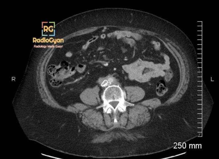 Maiden waist deformity | Radiology Signs