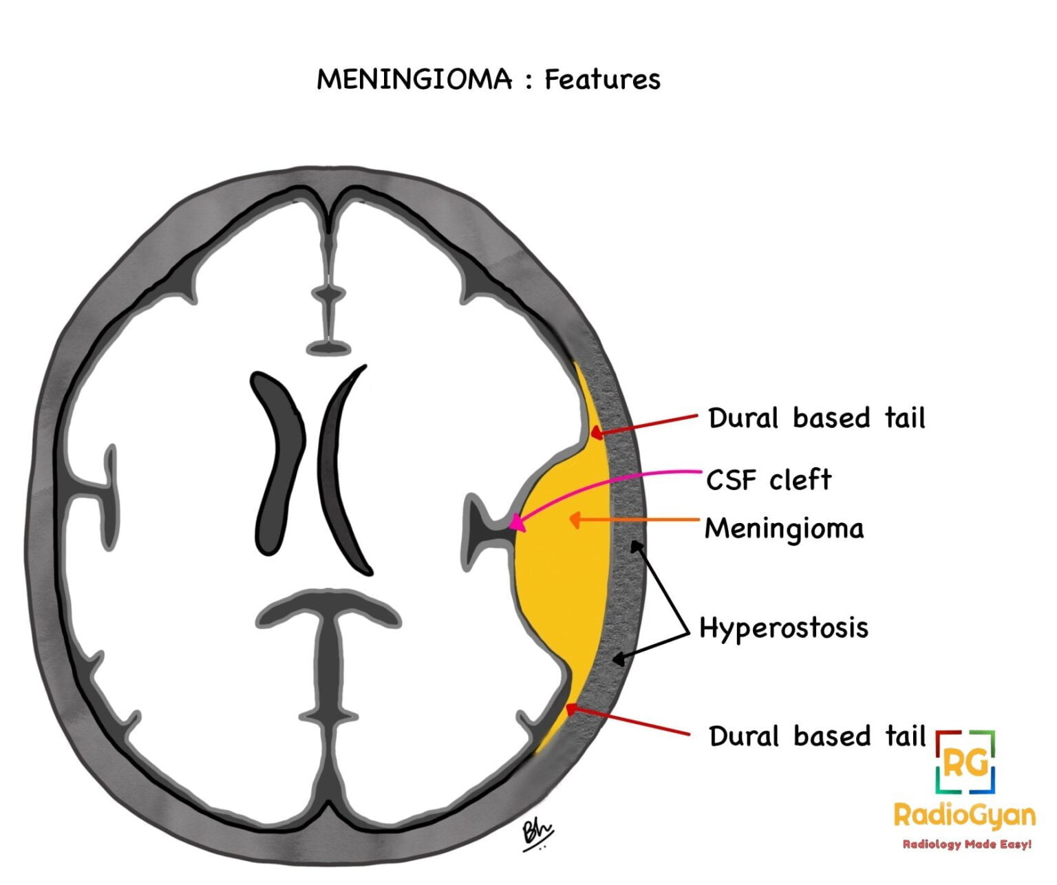 Meningioma | Radiology Case