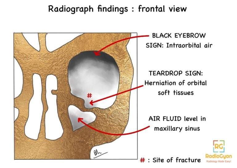 Blow out fracture of the Orbit | Radiology Case