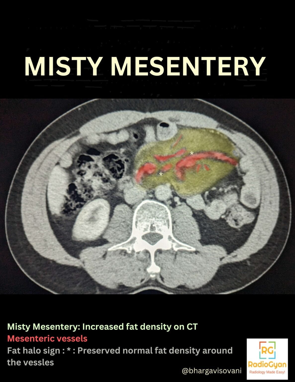 Misty Mesentery (Sclerosing Mesenteritis) | Radiology Case