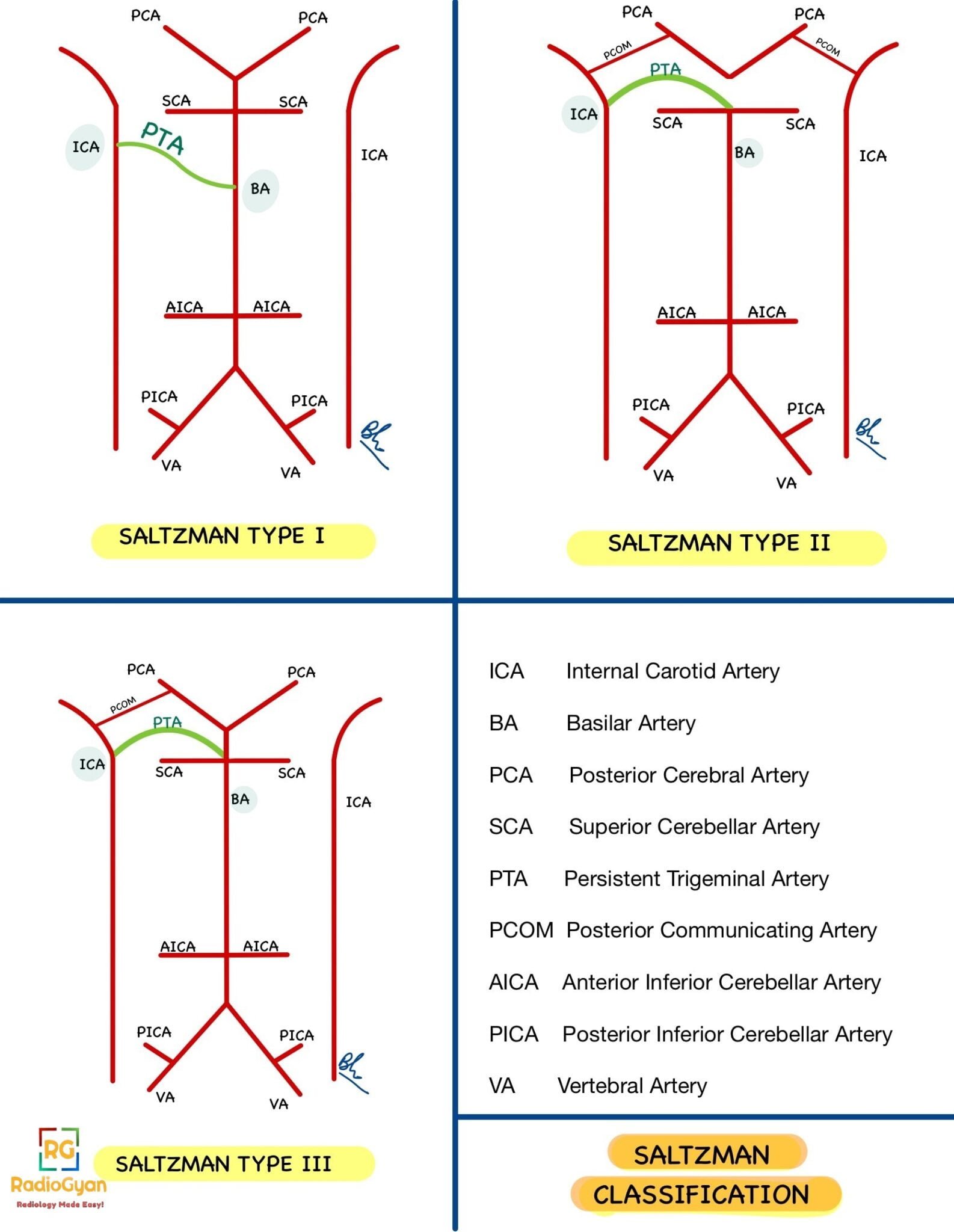 Persistent Trigeminal Artery | Radiology Case
