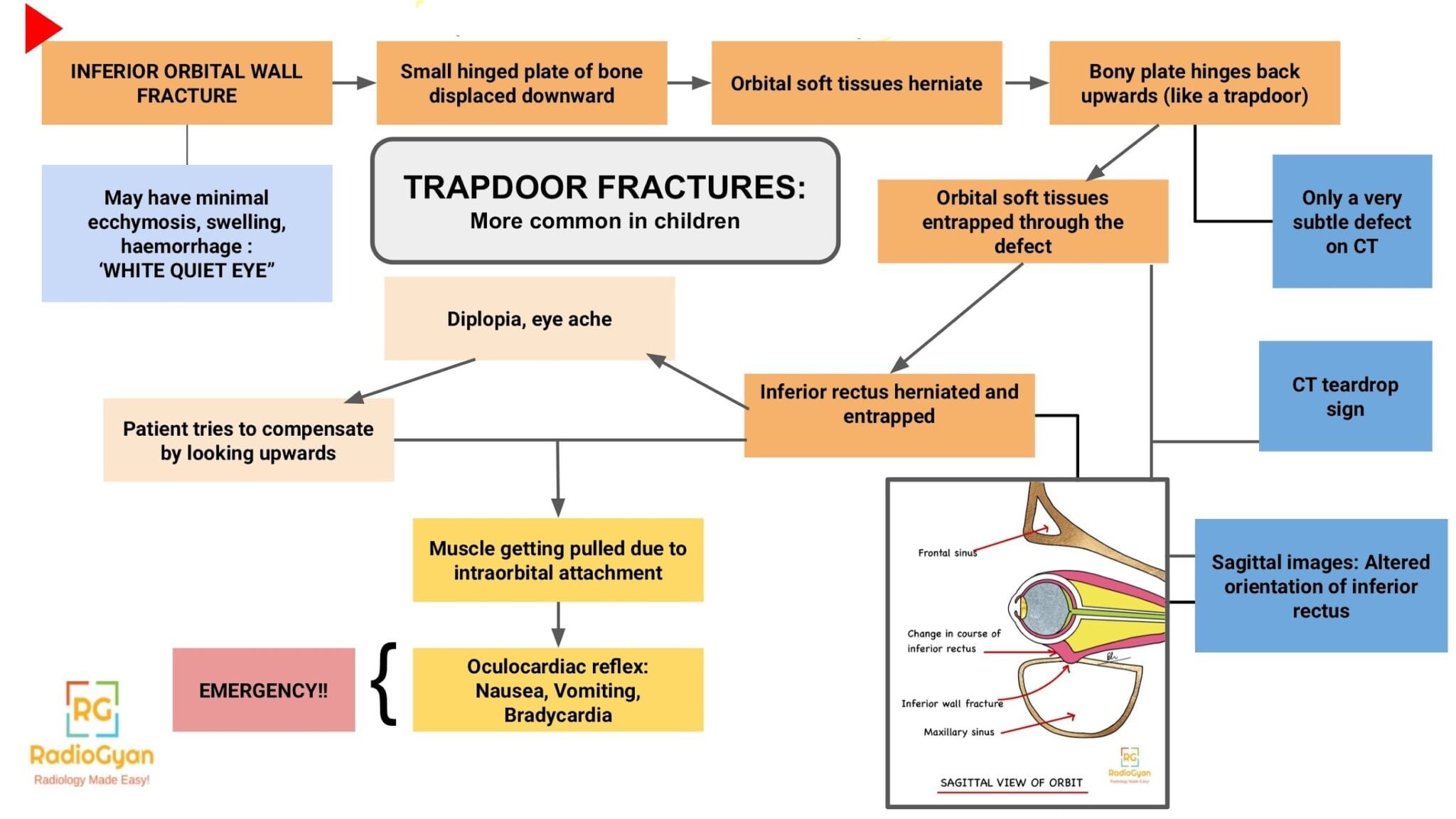 Blow out fracture of the Orbit | Radiology Case
