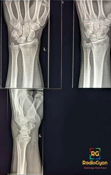 Triquetral Avulsion Fracture | Radiology Case | - RadioGyan