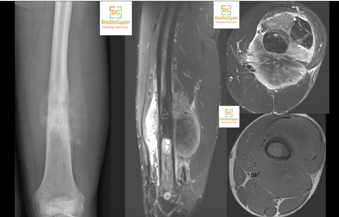 Sunburst periosteal reaction | Radiology Signs