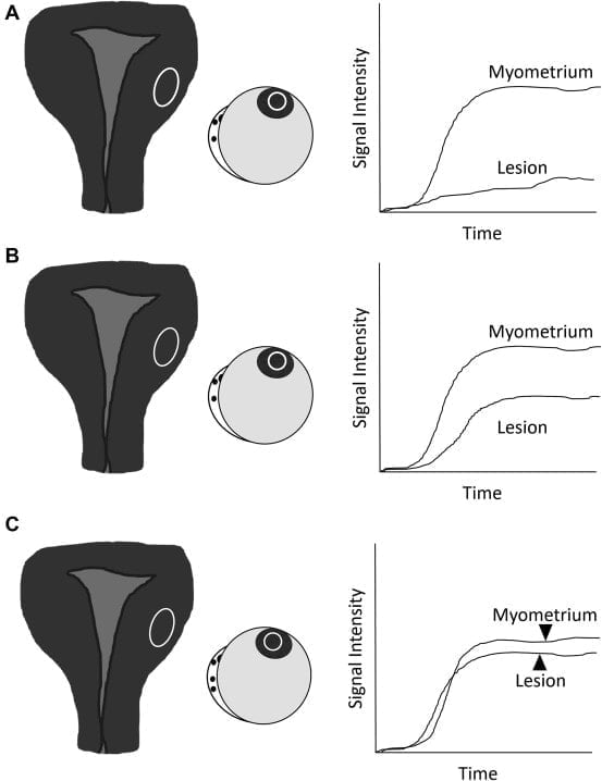 O-RADS MRI Calculator - RadioGyan