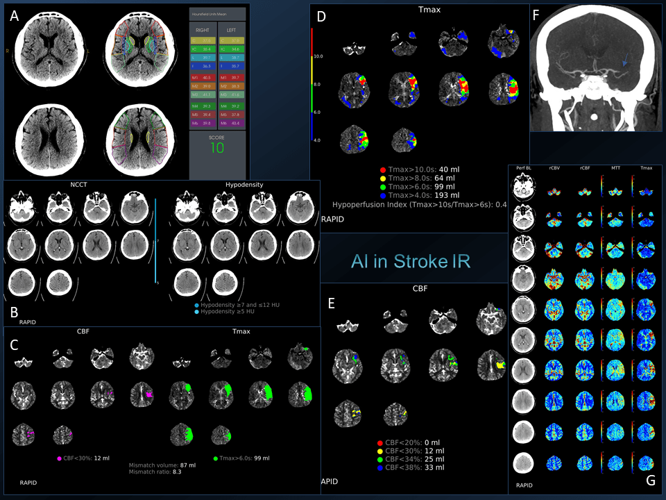 Interventional Radiology - All Your Questions Answered | Guides | RadioGyan