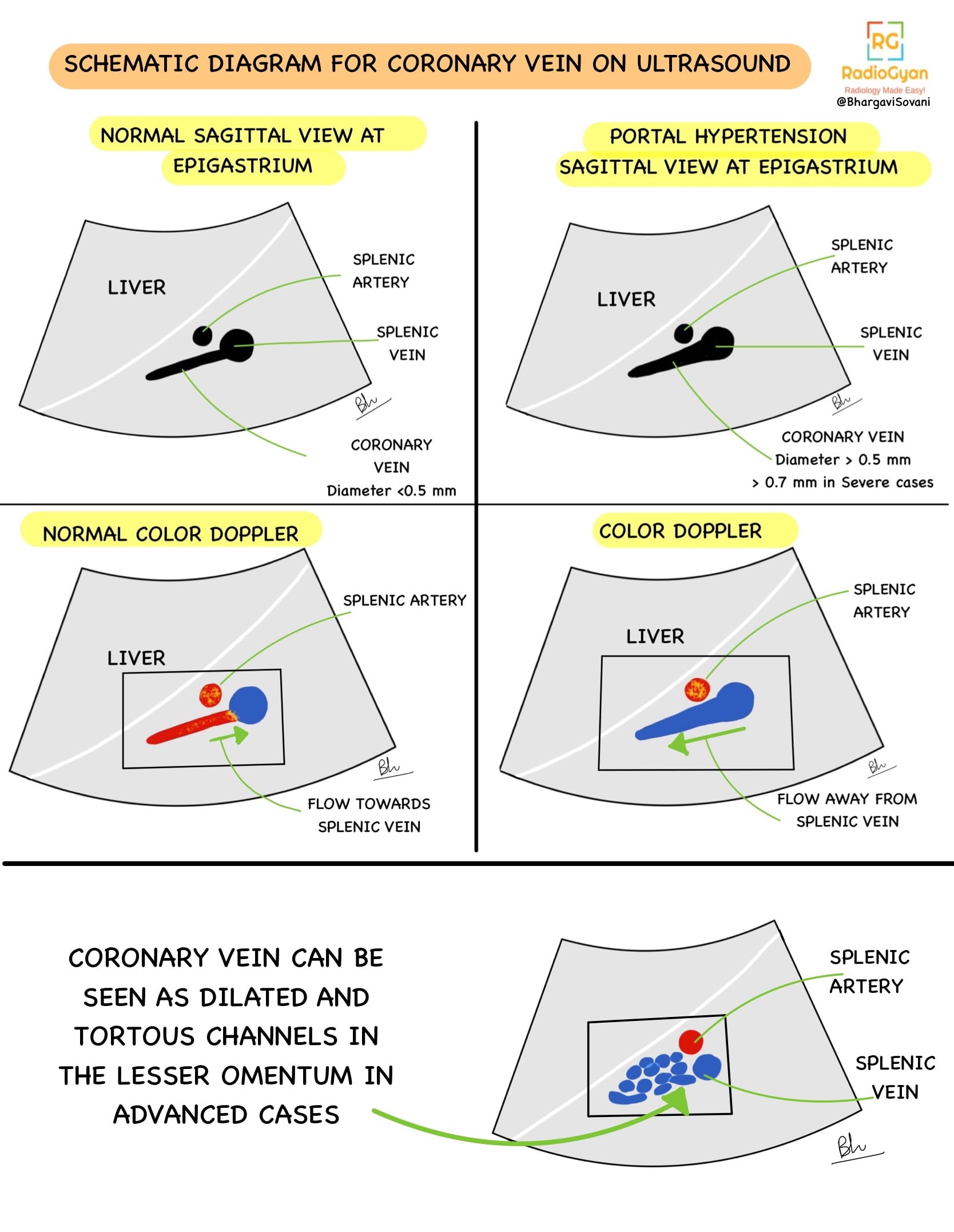 Cirrhosis and Portal Hypertension