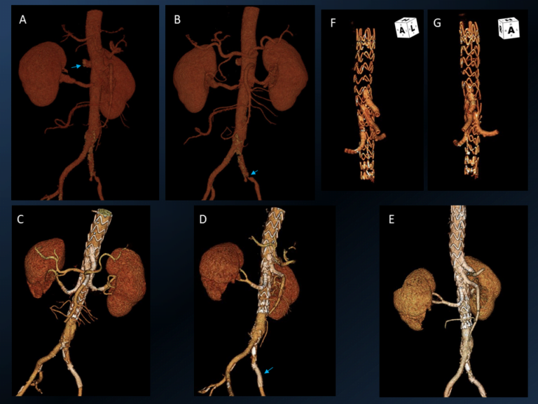 Interventional Radiology - All Your Questions Answered | Guides | RadioGyan