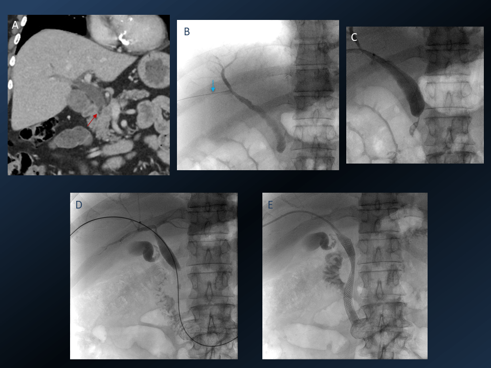 Interventional Radiology - All Your Questions Answered | Guides | RadioGyan