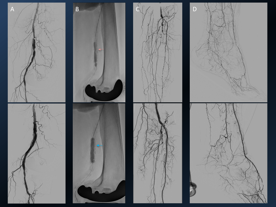 Interventional Radiology - All Your Questions Answered | Guides | RadioGyan