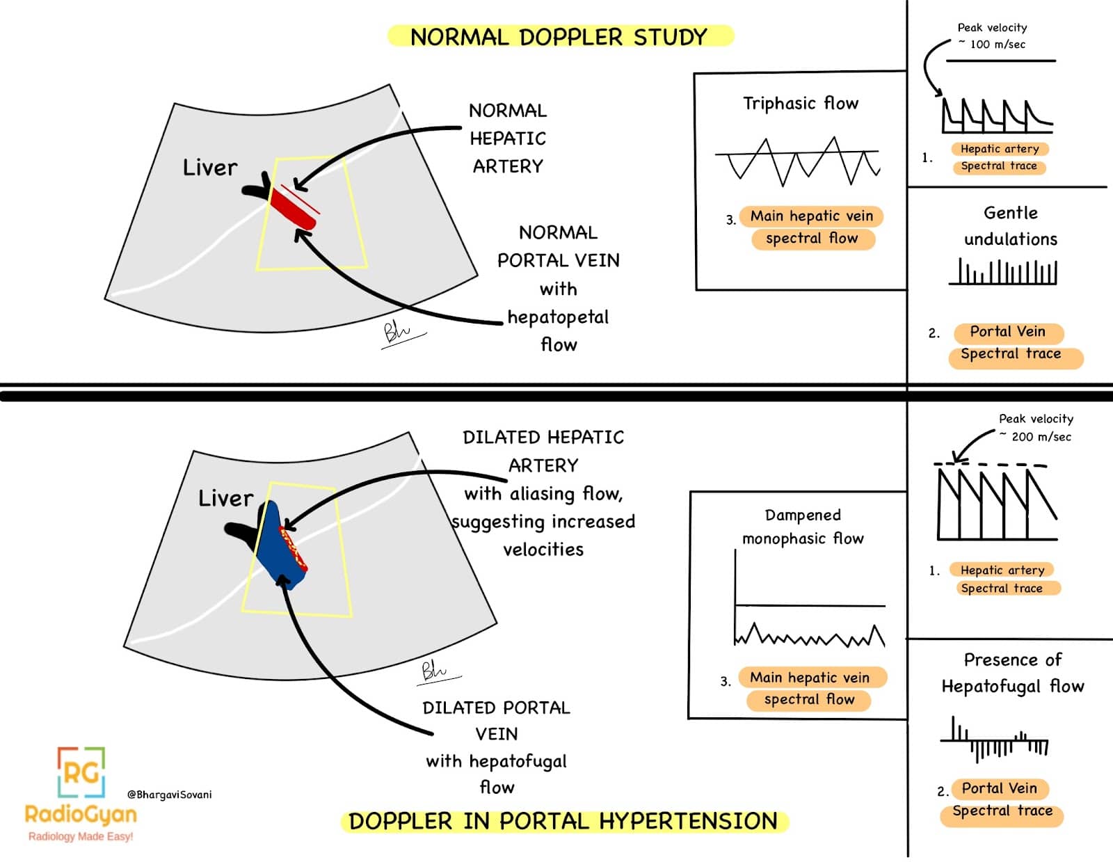 Cirrhosis and Portal Hypertension