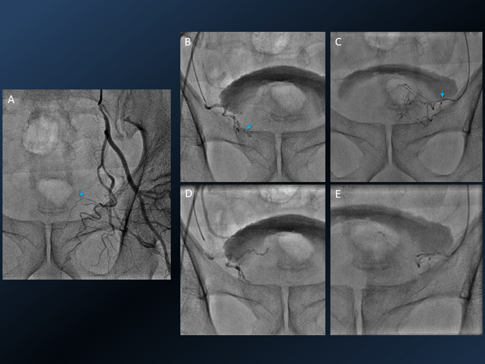 Interventional Radiology - All Your Questions Answered | Guides | RadioGyan