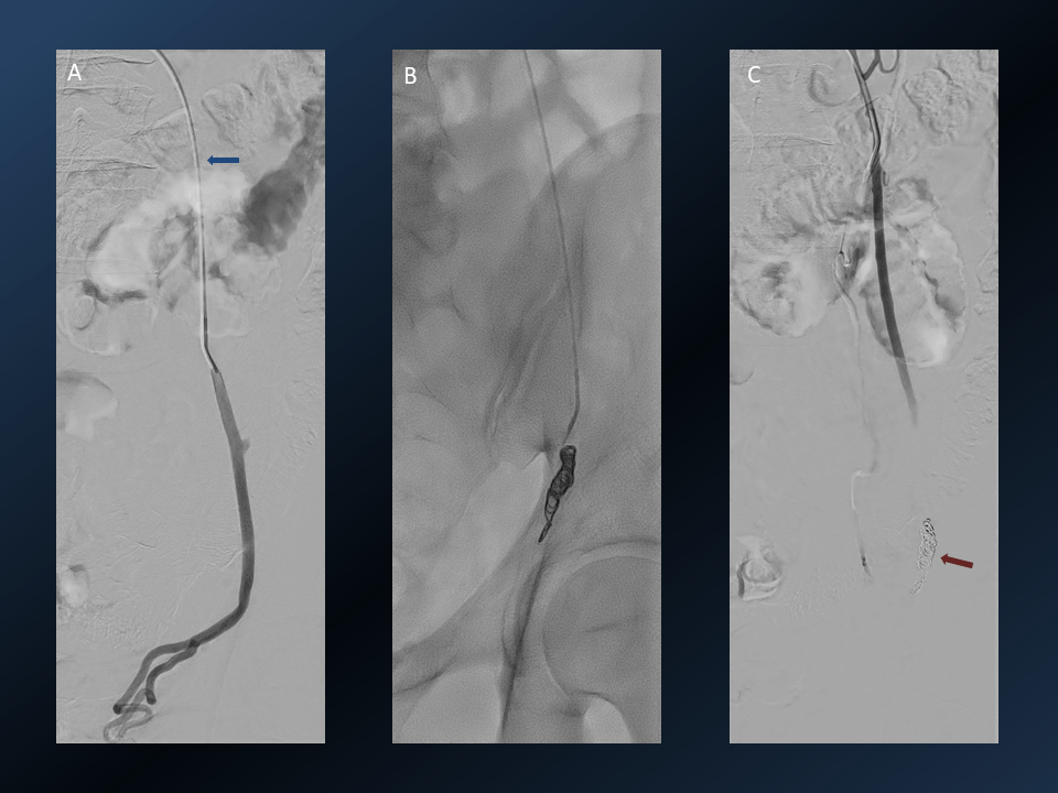 Interventional Radiology - All Your Questions Answered | Guides | RadioGyan