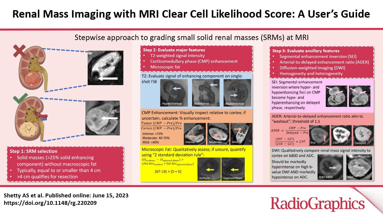 ccLS (Clear Cell Likelihood Score) Calculator For Solid Renal Masses on MRI