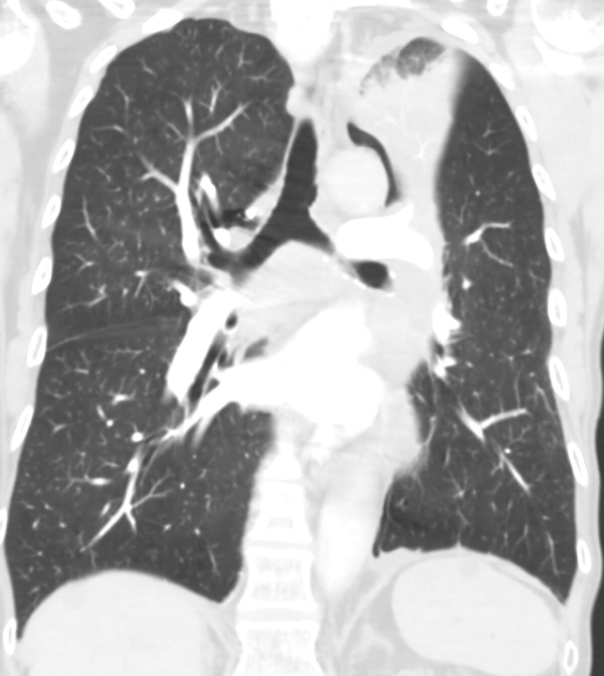 Luftsichel sign | Radiology Signs