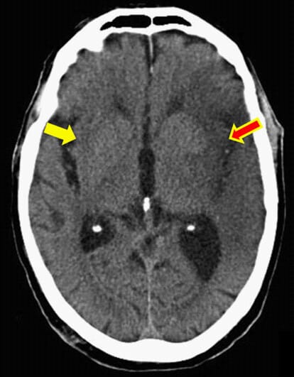 Insular ribbon sign | Radiology Signs