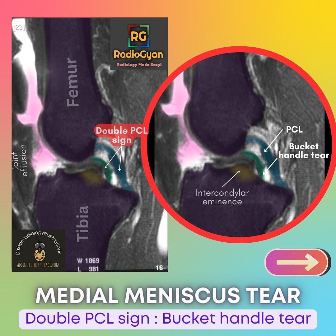 Bucket handle tear | Radiology Signs